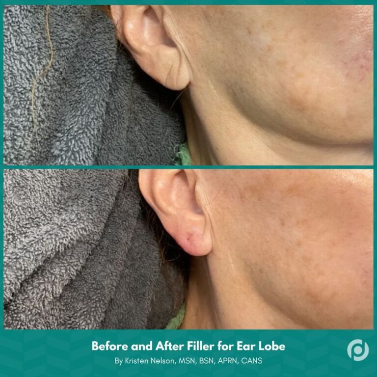 Before & After Gallery - Pure Dermatology