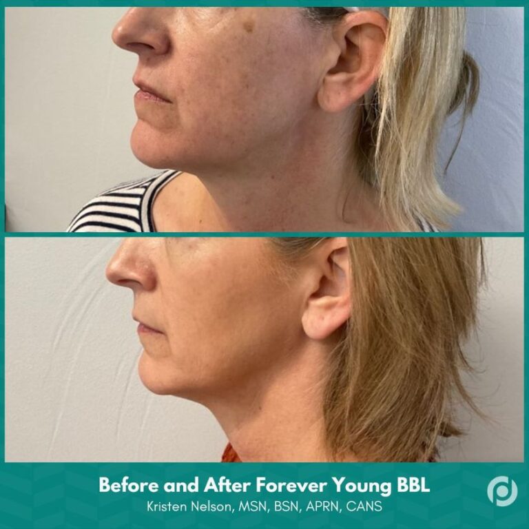 BBL Treatments - Pure Dermatology