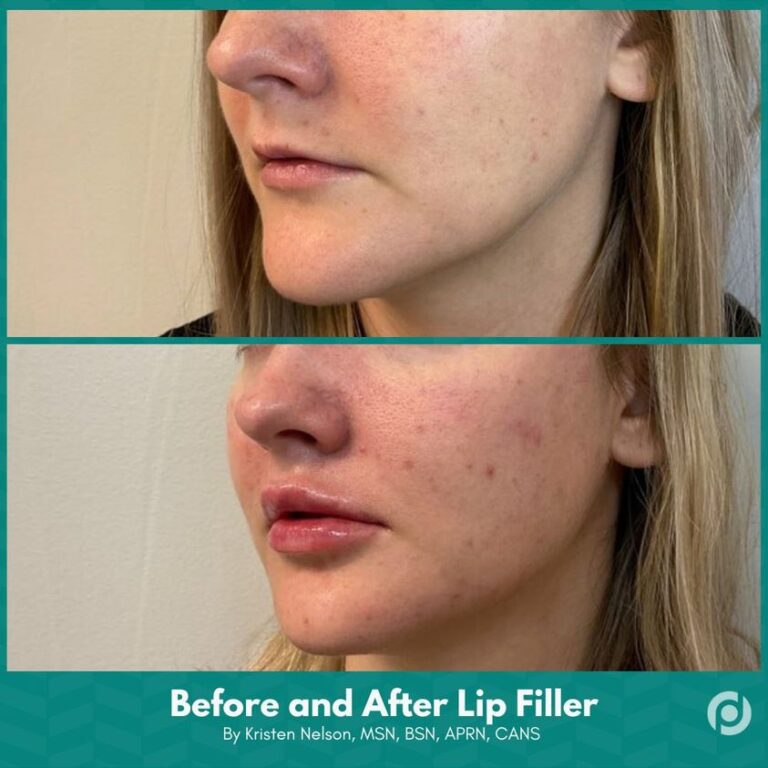 Before & After Gallery - Pure Dermatology