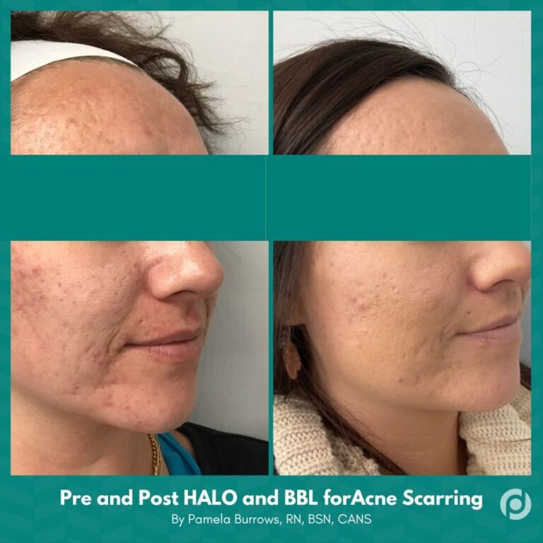 BBL Treatments - Pure Dermatology