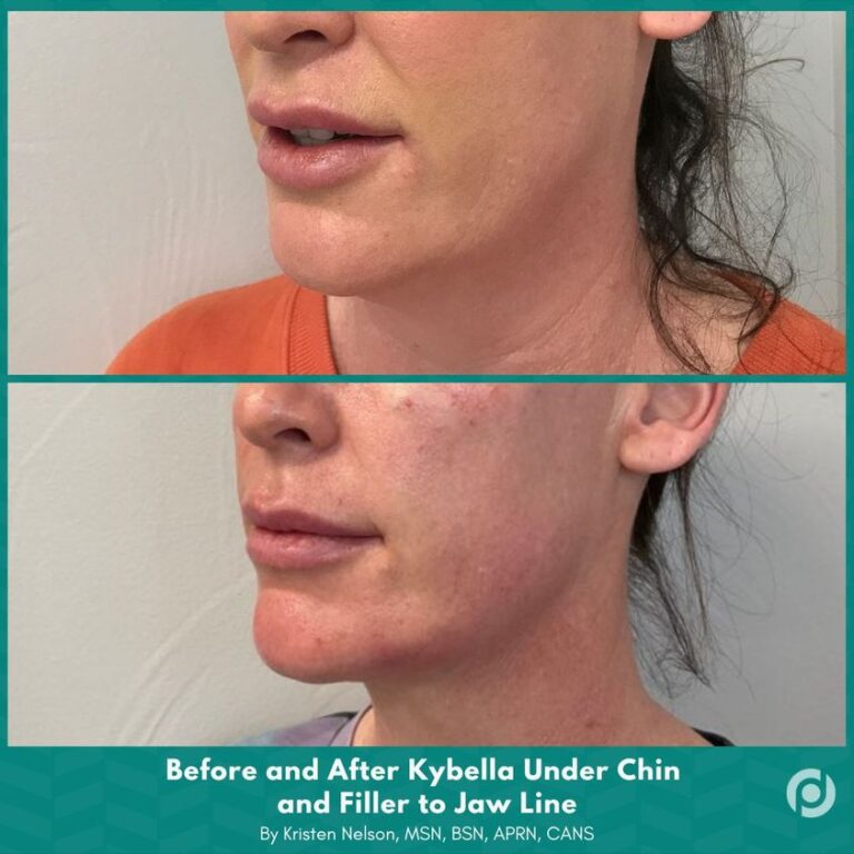 Kybella® - Pure Dermatology